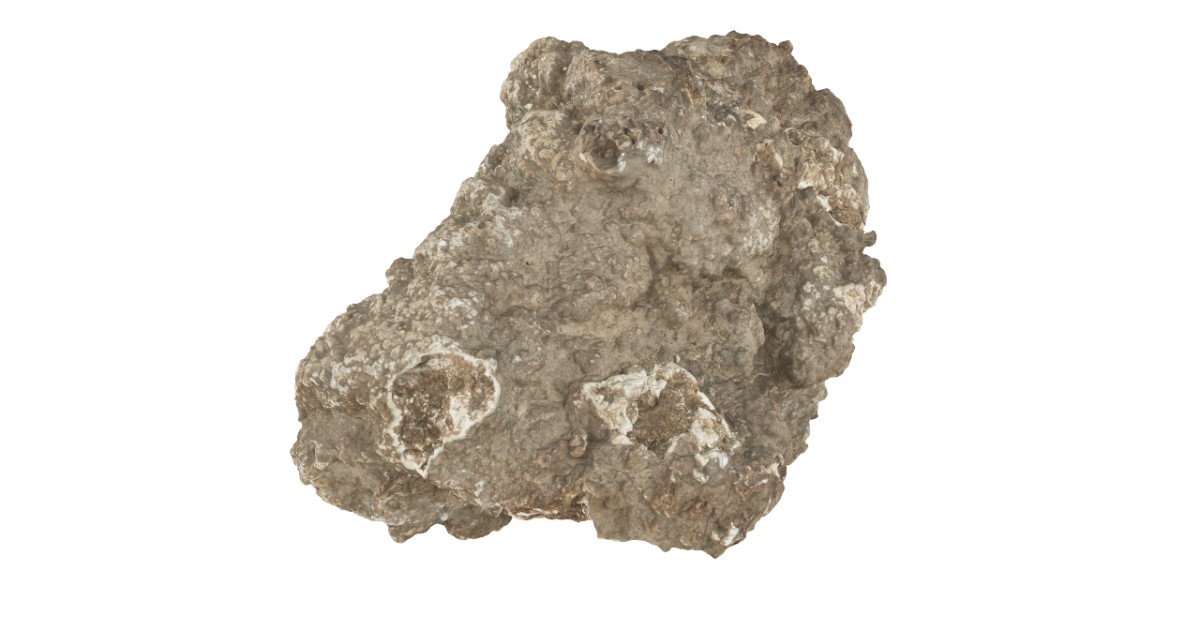 Bladder Stone | Autodesk Community Gallery