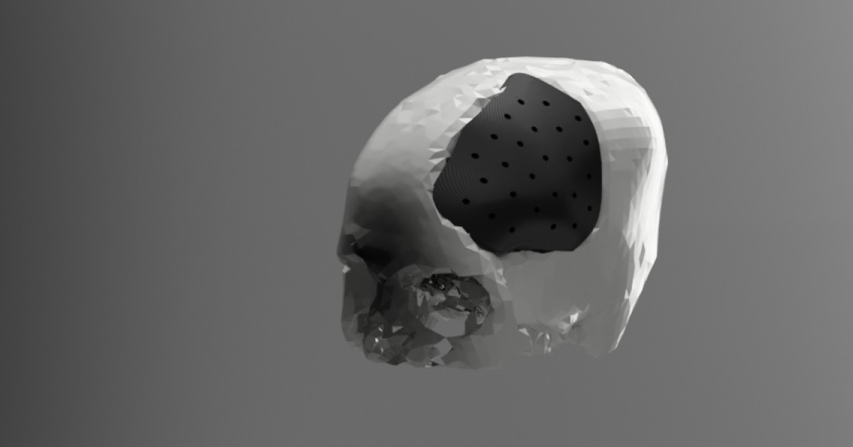 Reconstruction of skull defects | Autodesk Community Gallery