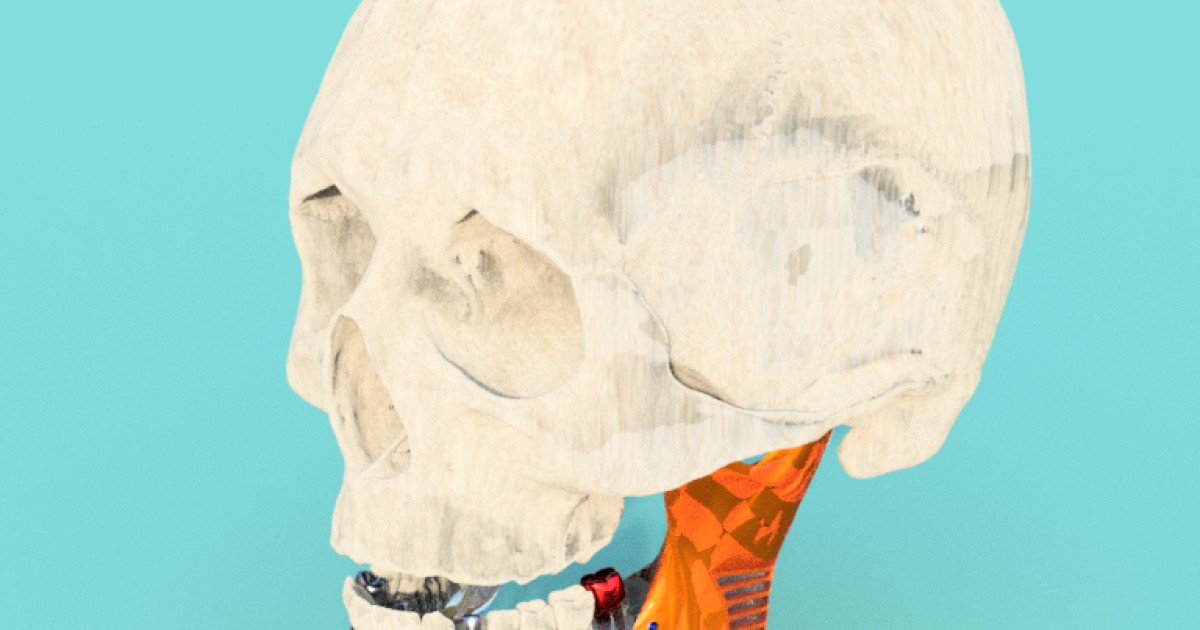 Partial Jaw Prosthesis - Kama'ach-Dentprotx | Autodesk Community Gallery